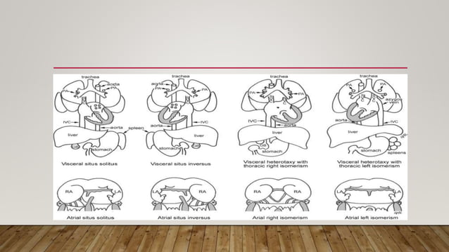 Heterotaxy syndrome.pptx | Heart and Cardiovascular Diseases | Diseases ...