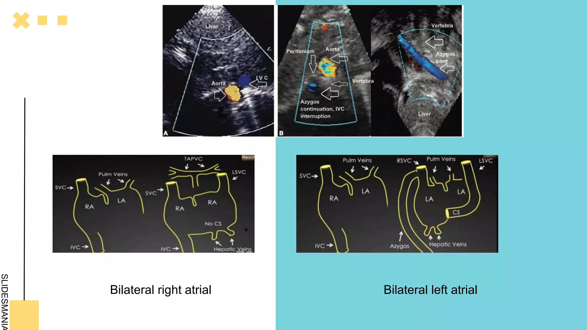 heterotaxy syndrome.pptx