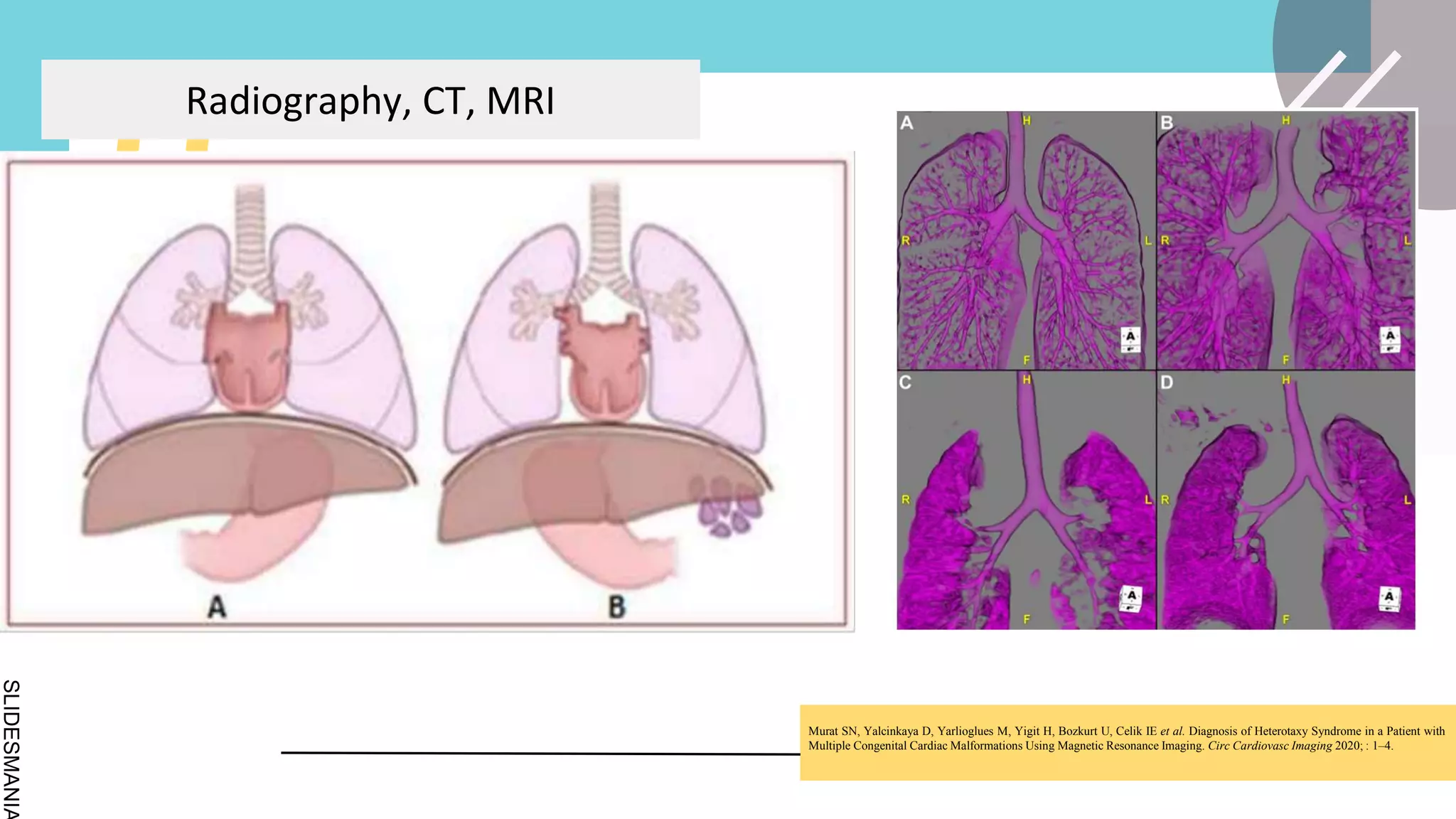 heterotaxy syndrome.pptx