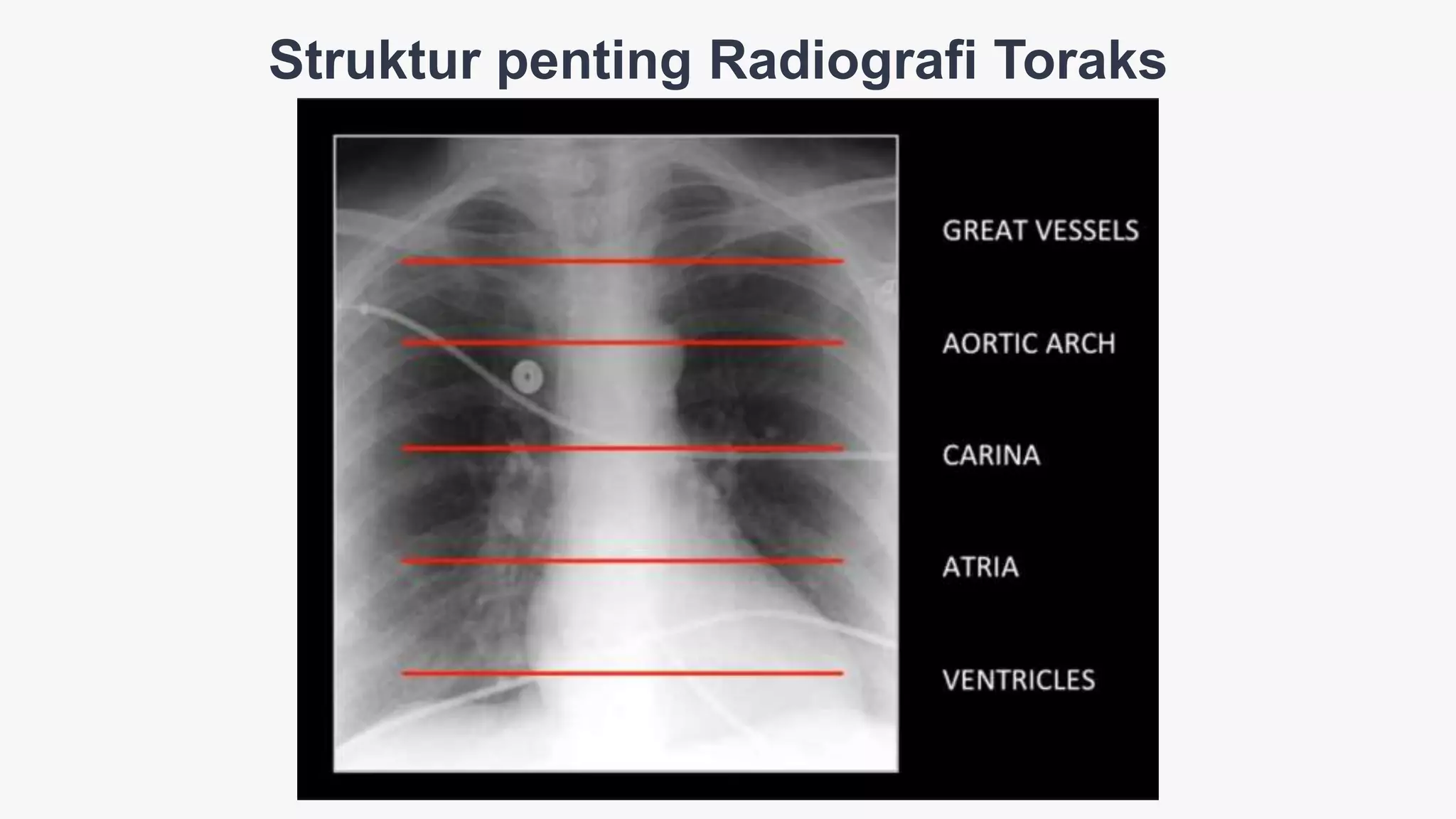 Dasar CT Scan Toraks.pptx