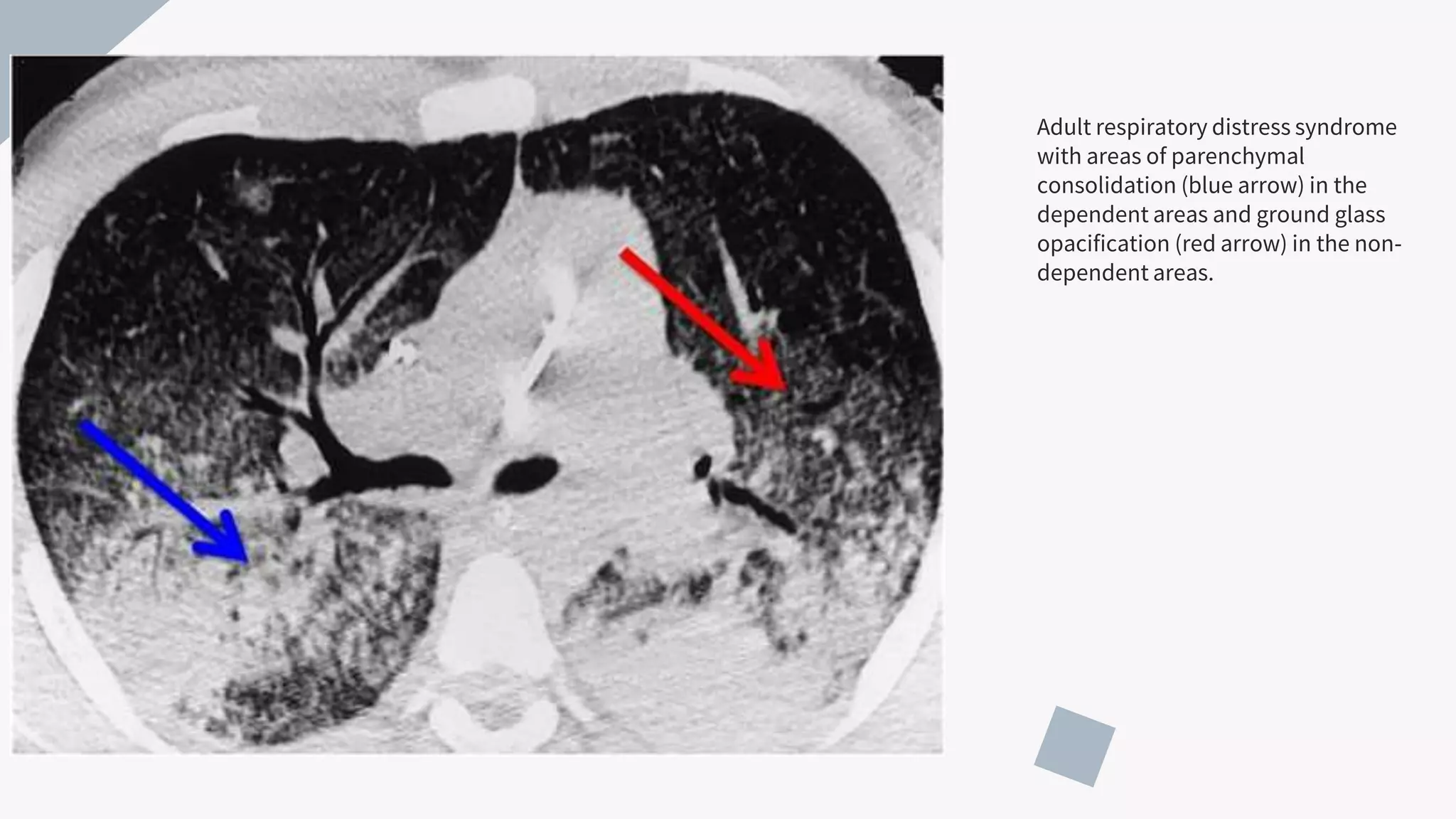 Dasar CT Scan Toraks.pptx