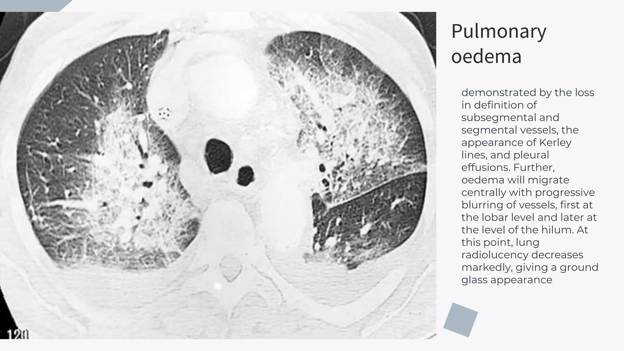 Dasar CT Scan Toraks.pptx