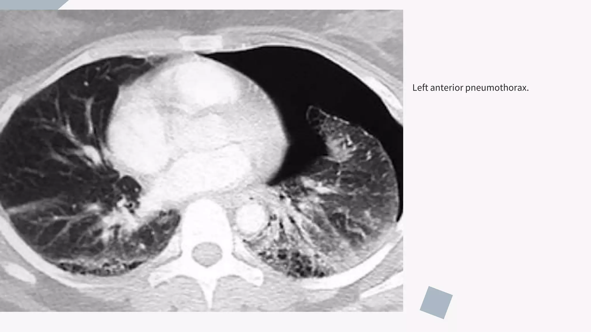 Dasar CT Scan Toraks.pptx