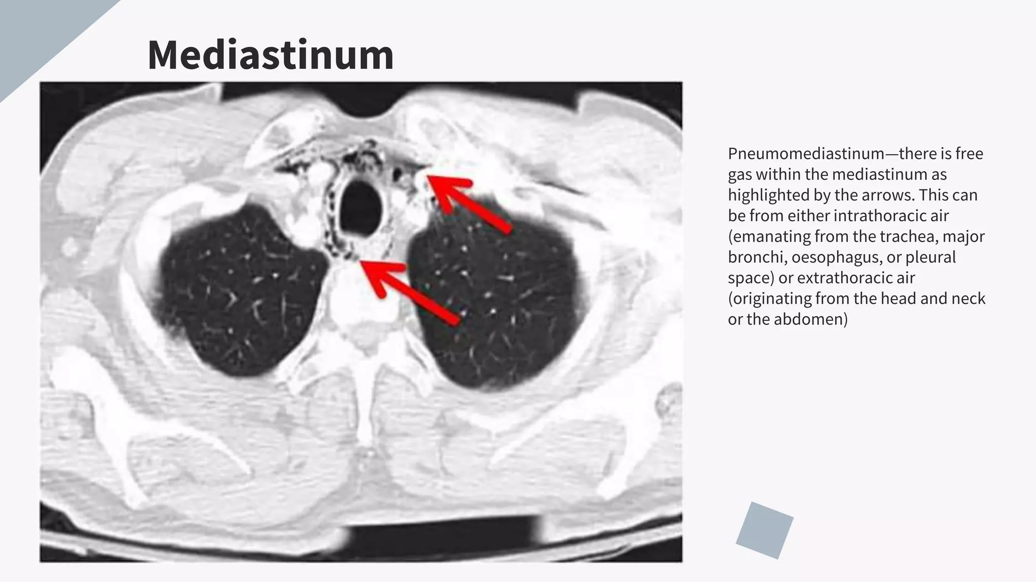 Dasar CT Scan Toraks.pptx