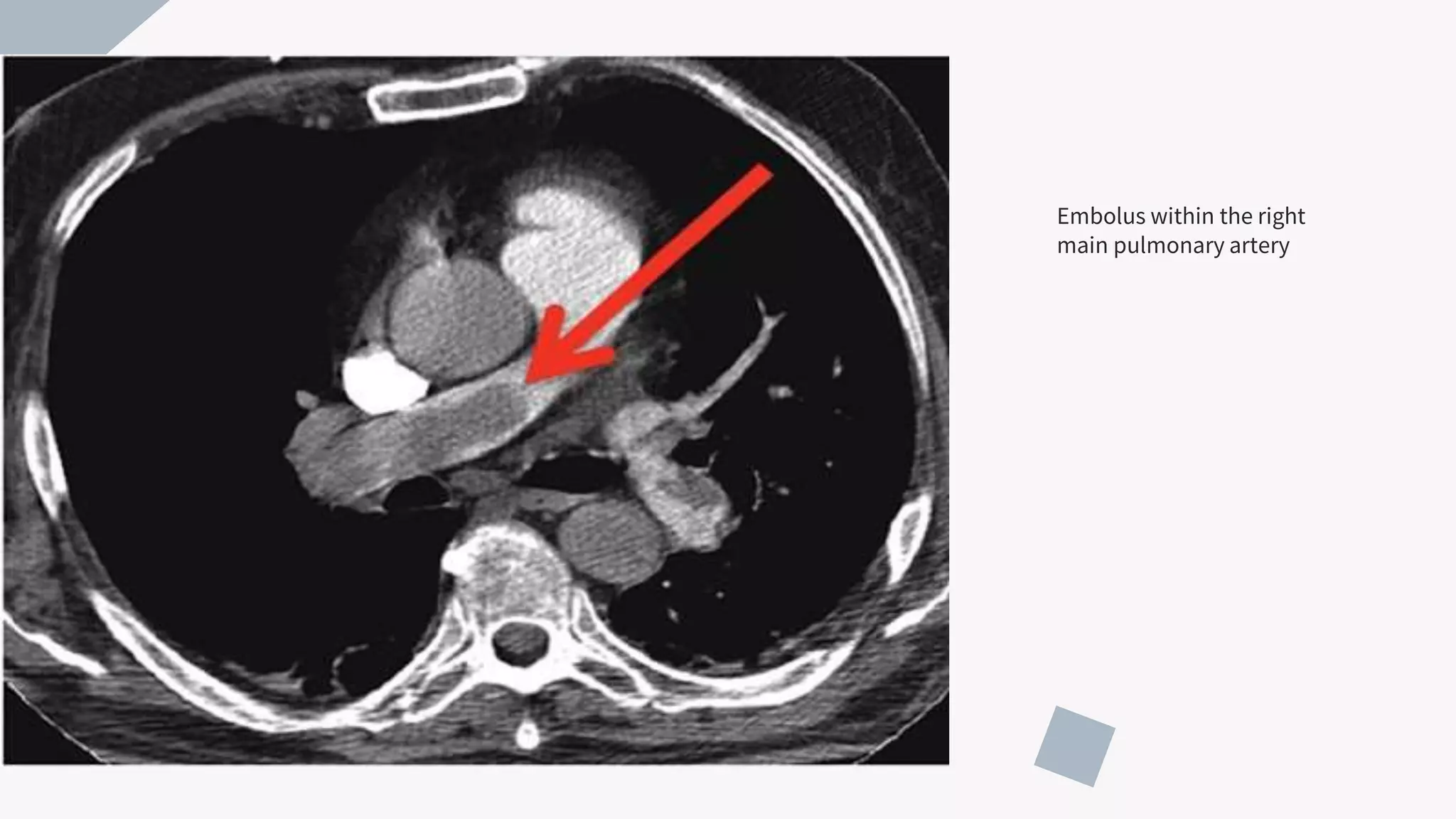 Dasar CT Scan Toraks.pptx