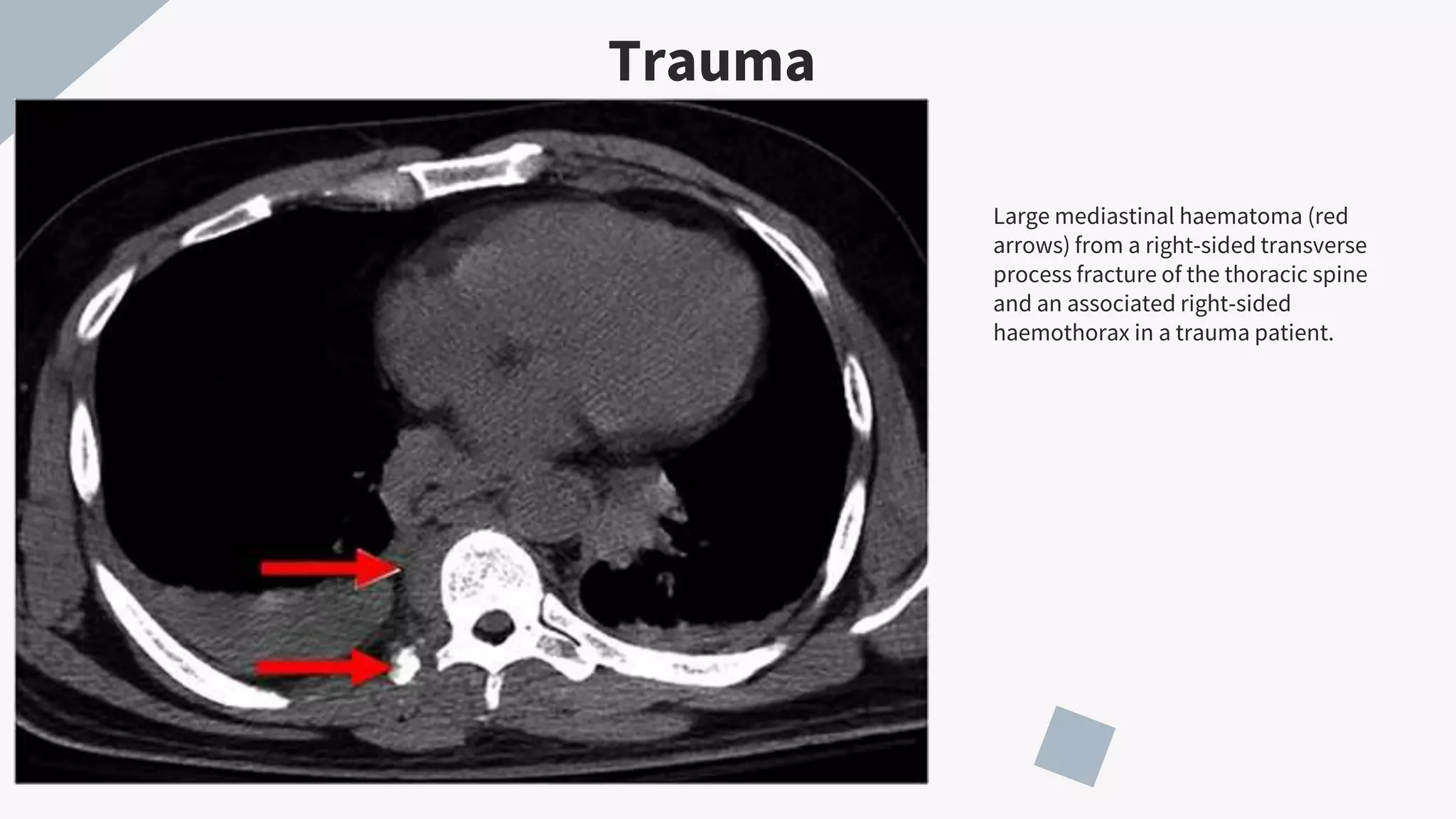 Dasar CT Scan Toraks.pptx