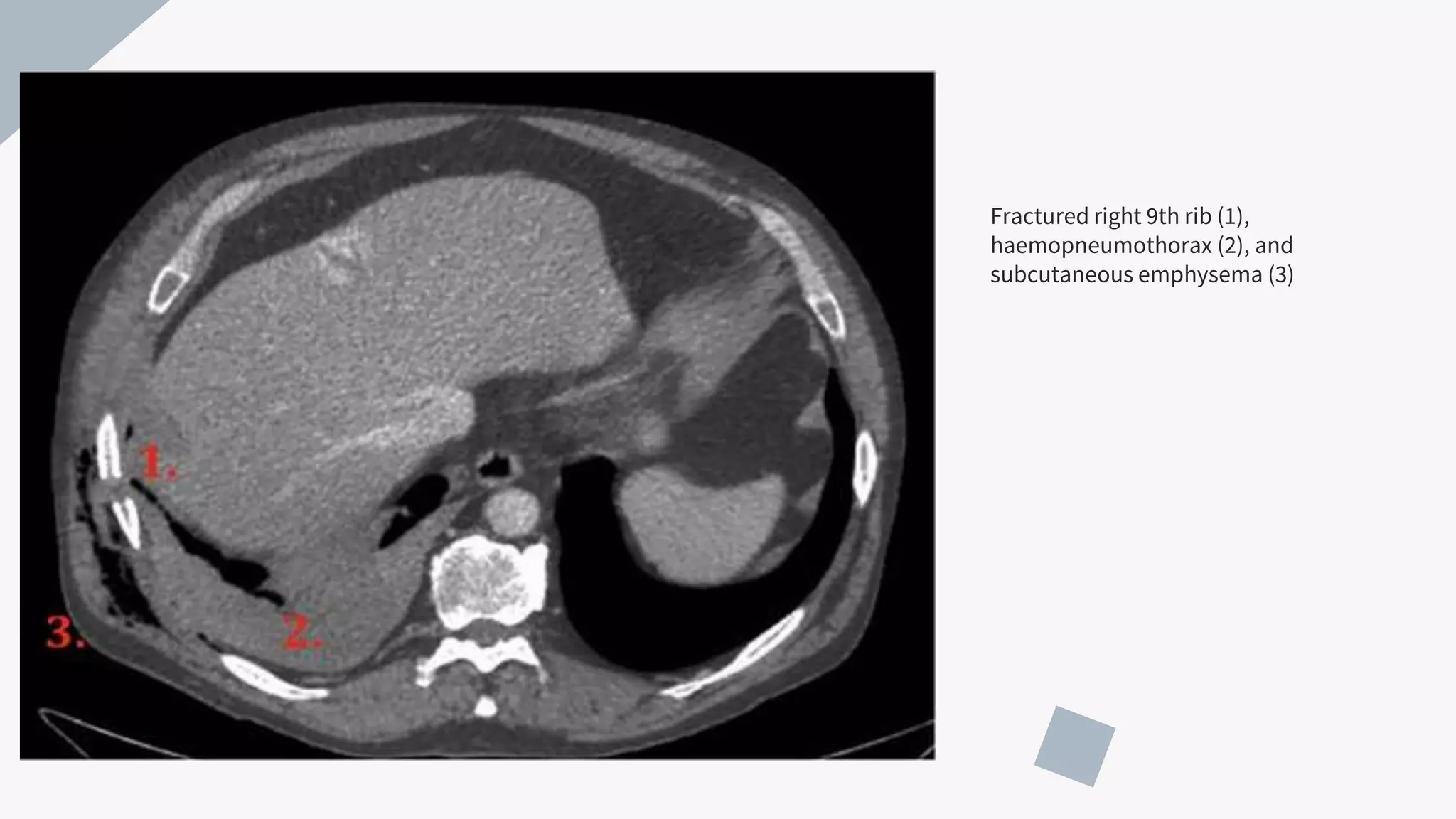 Dasar CT Scan Toraks.pptx