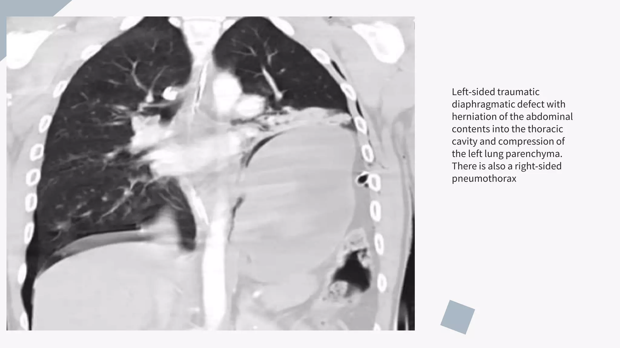 Dasar CT Scan Toraks.pptx