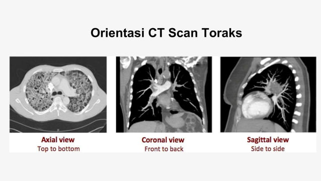 Dasar CT Scan Toraks.pptx
