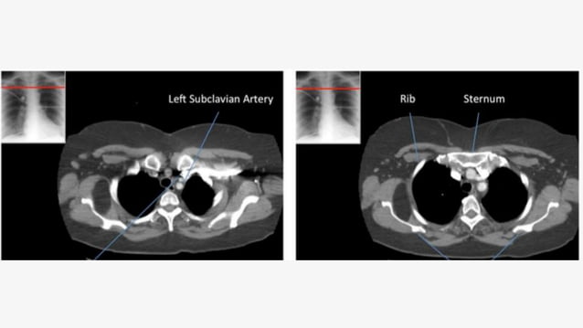Dasar CT Scan Toraks.pptx