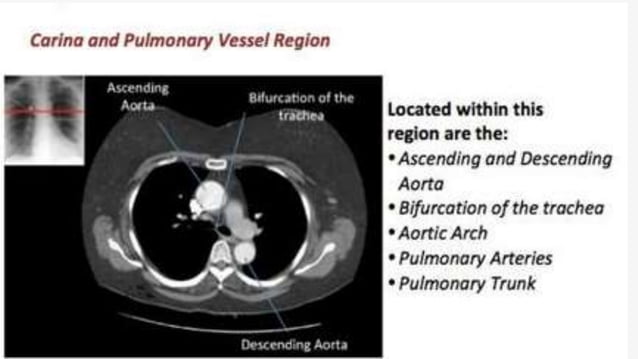 Dasar CT Scan Toraks.pptx