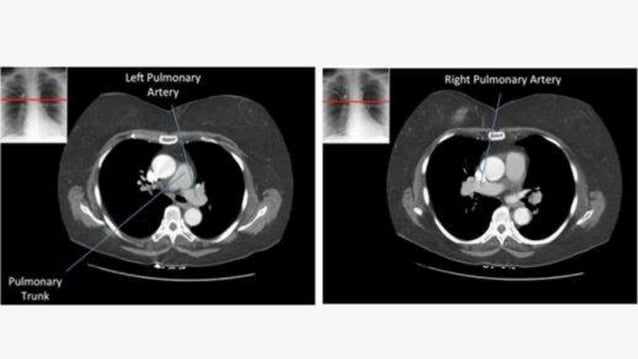 Dasar CT Scan Toraks.pptx
