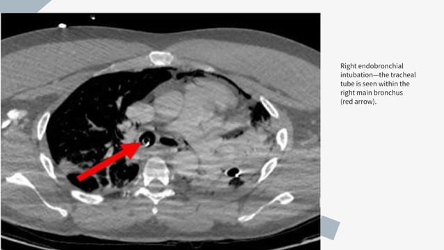 Dasar CT Scan Toraks.pptx