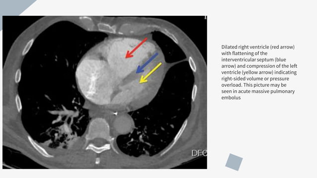 Dasar CT Scan Toraks.pptx