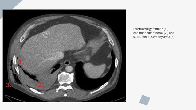 Dasar CT Scan Toraks.pptx