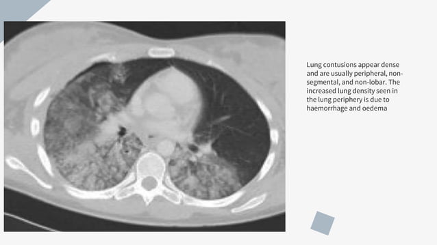 Dasar CT Scan Toraks.pptx