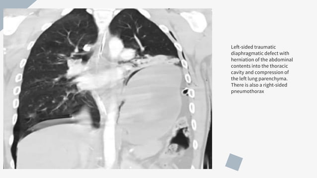 Dasar CT Scan Toraks.pptx