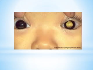 Leukocorie | PDF | Eye and Vision Conditions | Diseases and Conditions