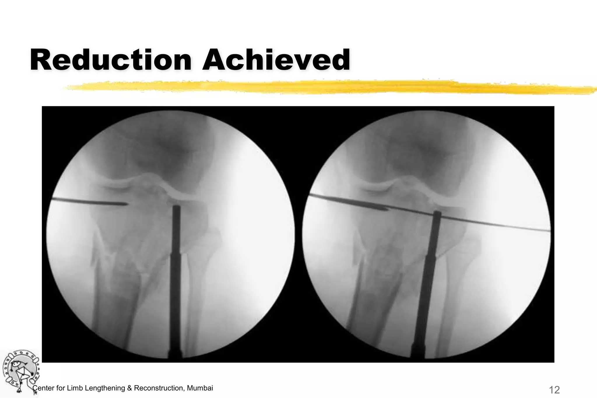 Use of Ilizarov fixator Hexapod apparatus for fracture prox tibia | PPTX