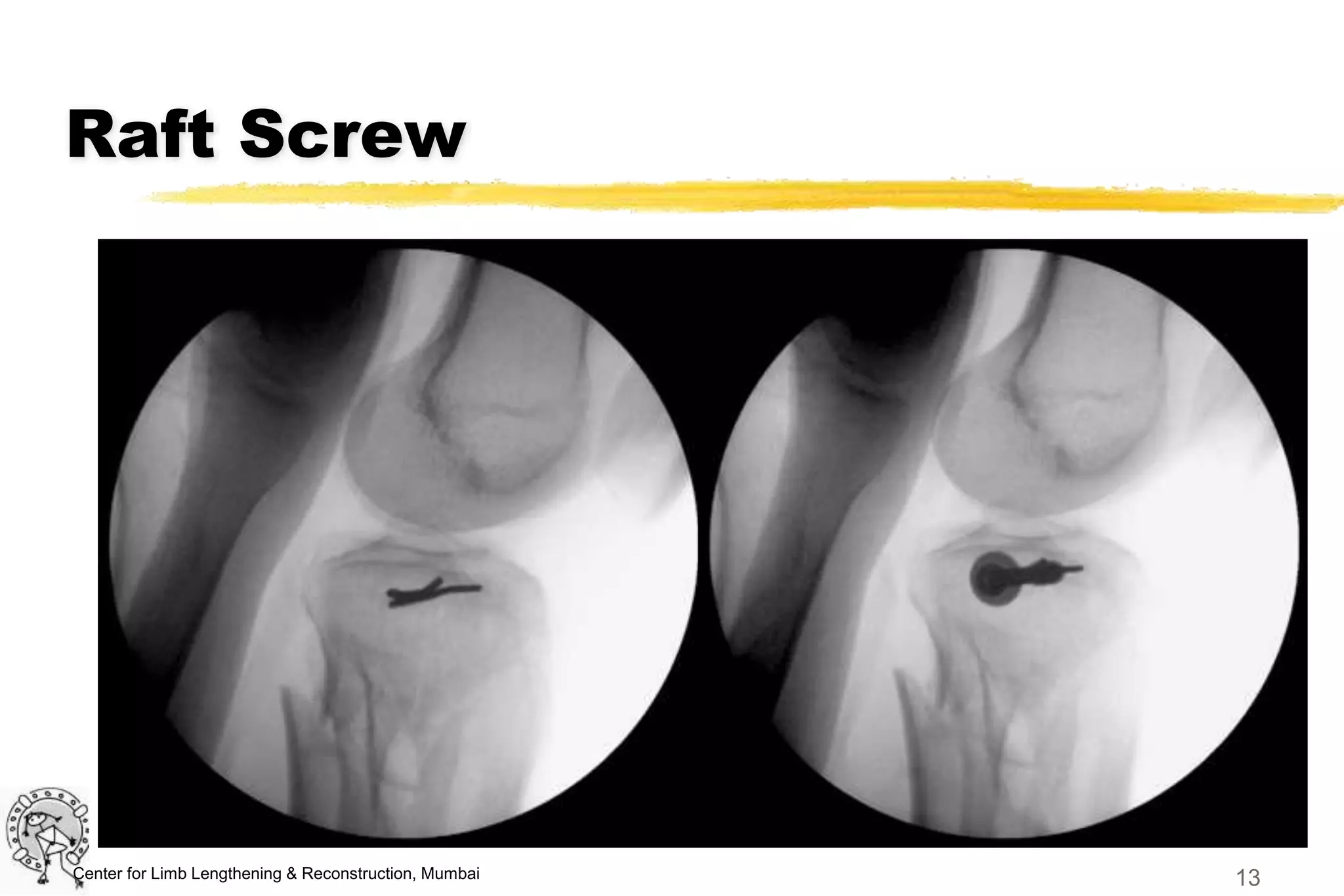 Use of Ilizarov fixator Hexapod apparatus for fracture prox tibia | PPTX
