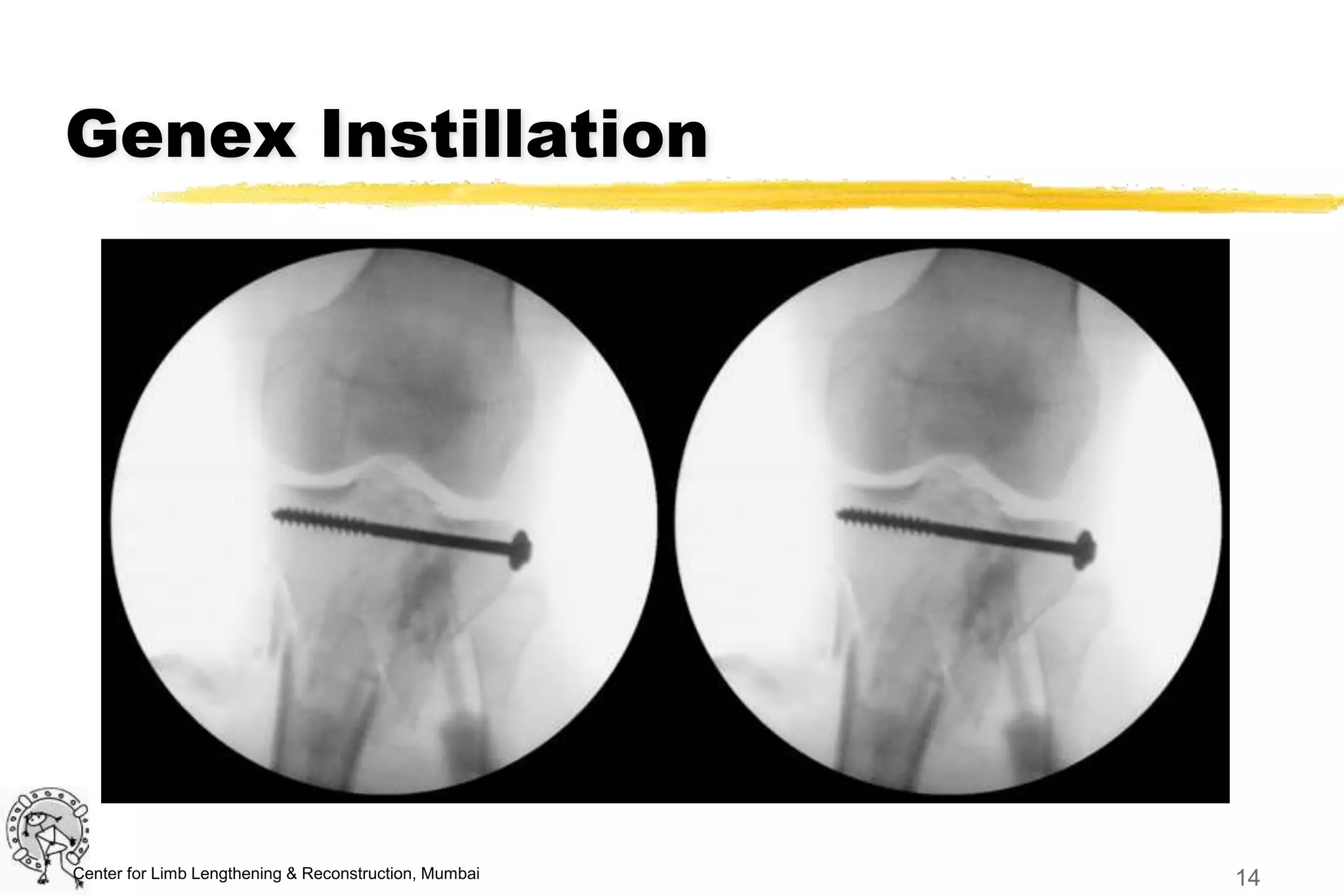 Use of Ilizarov fixator Hexapod apparatus for fracture prox tibia | PPTX