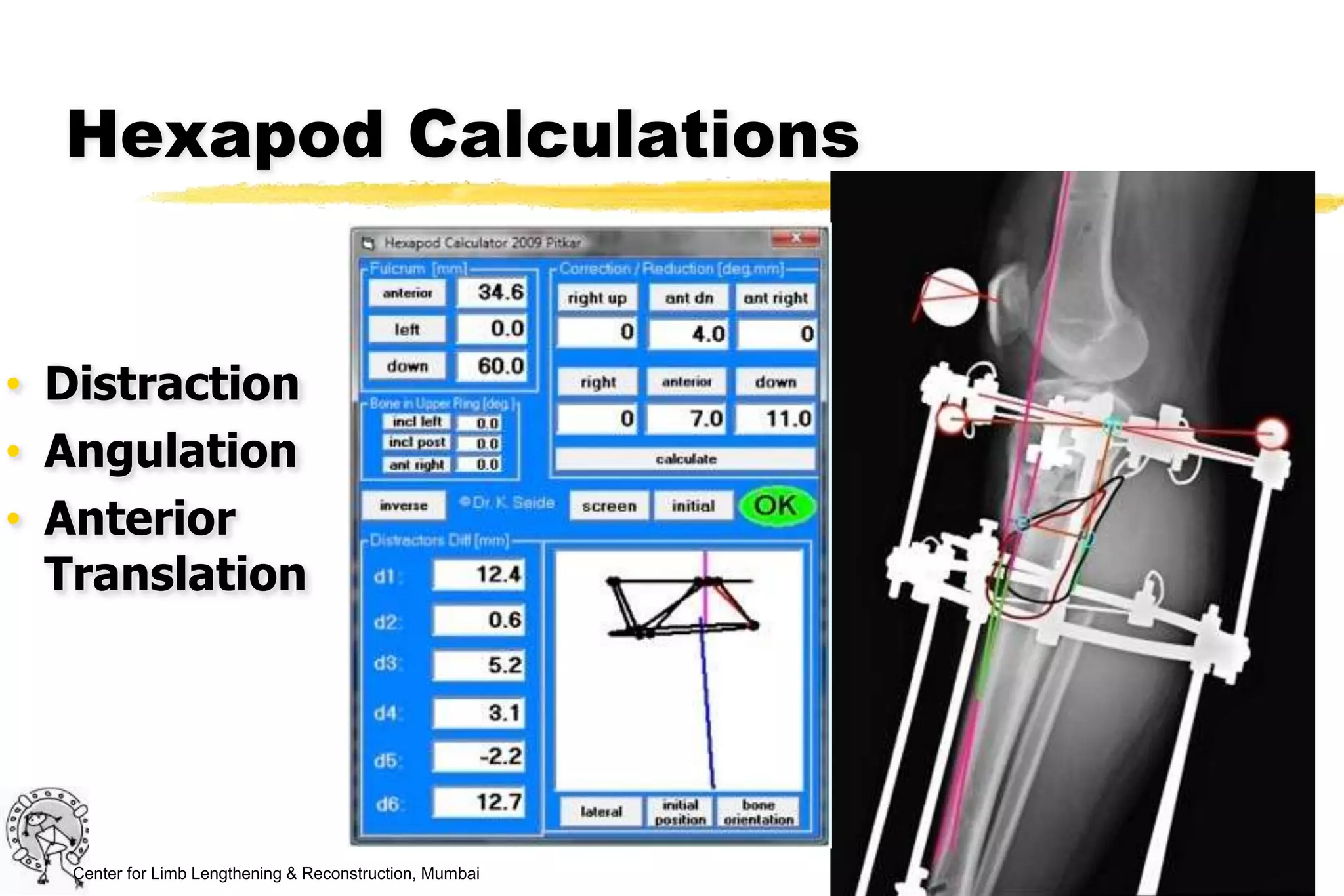 Use of Ilizarov fixator Hexapod apparatus for fracture prox tibia | PPTX