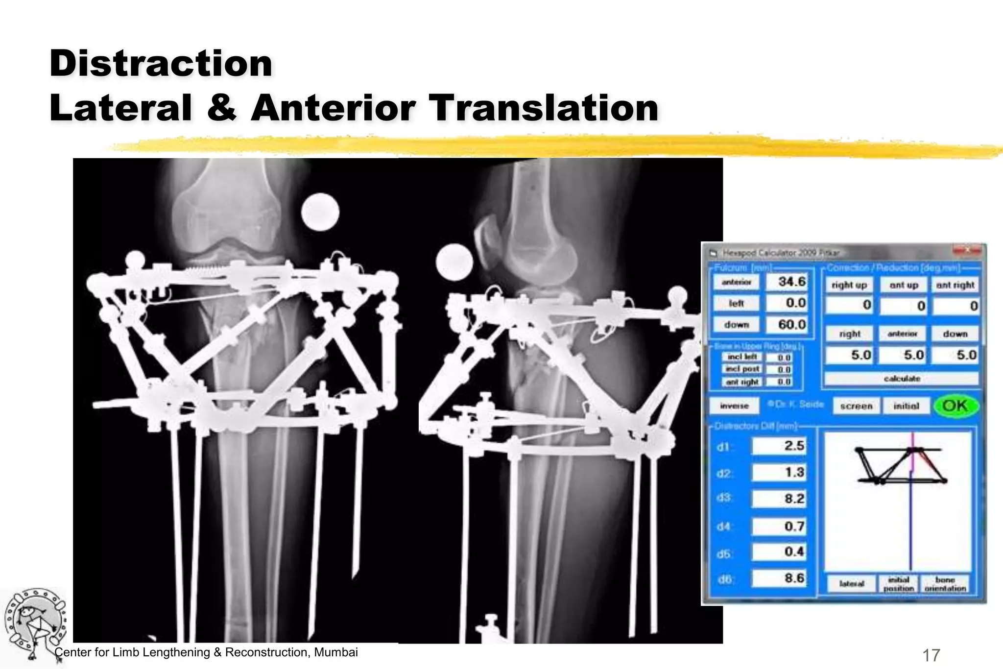 Use of Ilizarov fixator Hexapod apparatus for fracture prox tibia | PPTX