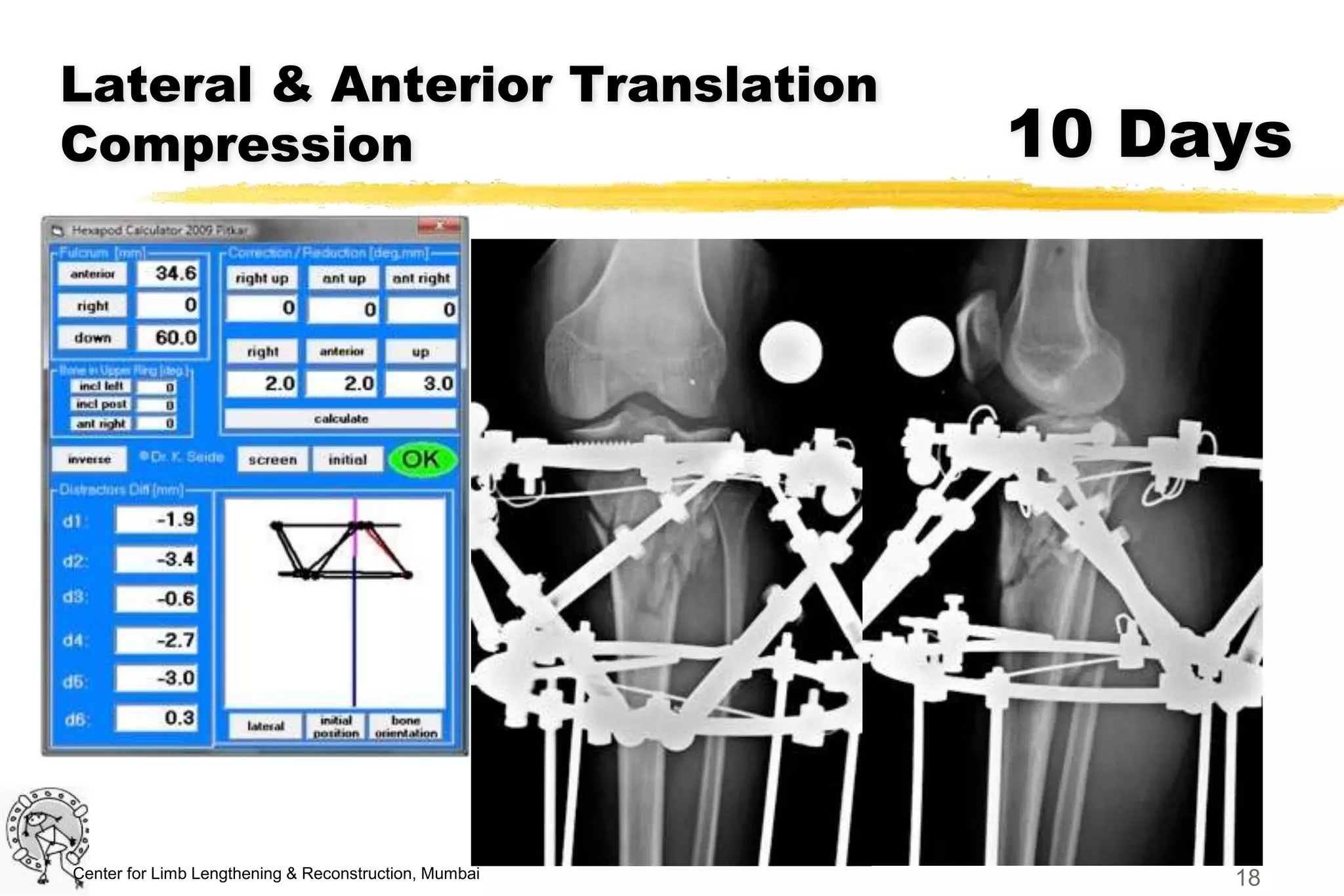 Use of Ilizarov fixator Hexapod apparatus for fracture prox tibia | PPTX