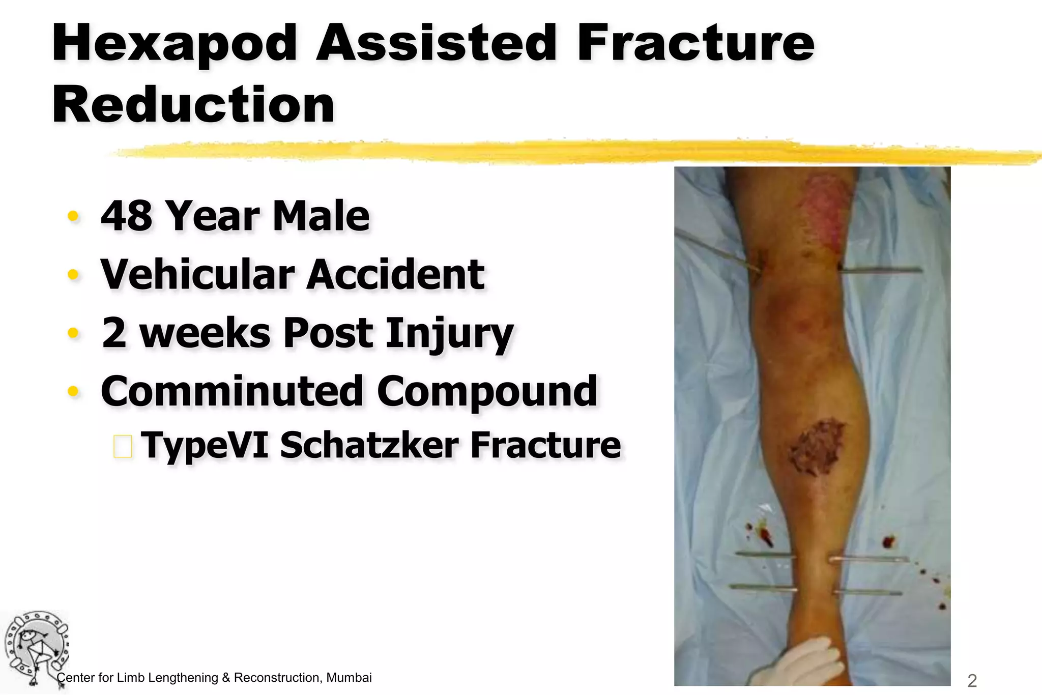 Use of Ilizarov fixator Hexapod apparatus for fracture prox tibia | PPTX