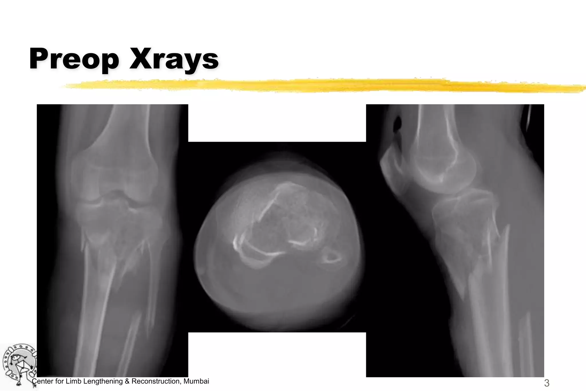 Use of Ilizarov fixator Hexapod apparatus for fracture prox tibia | PPTX
