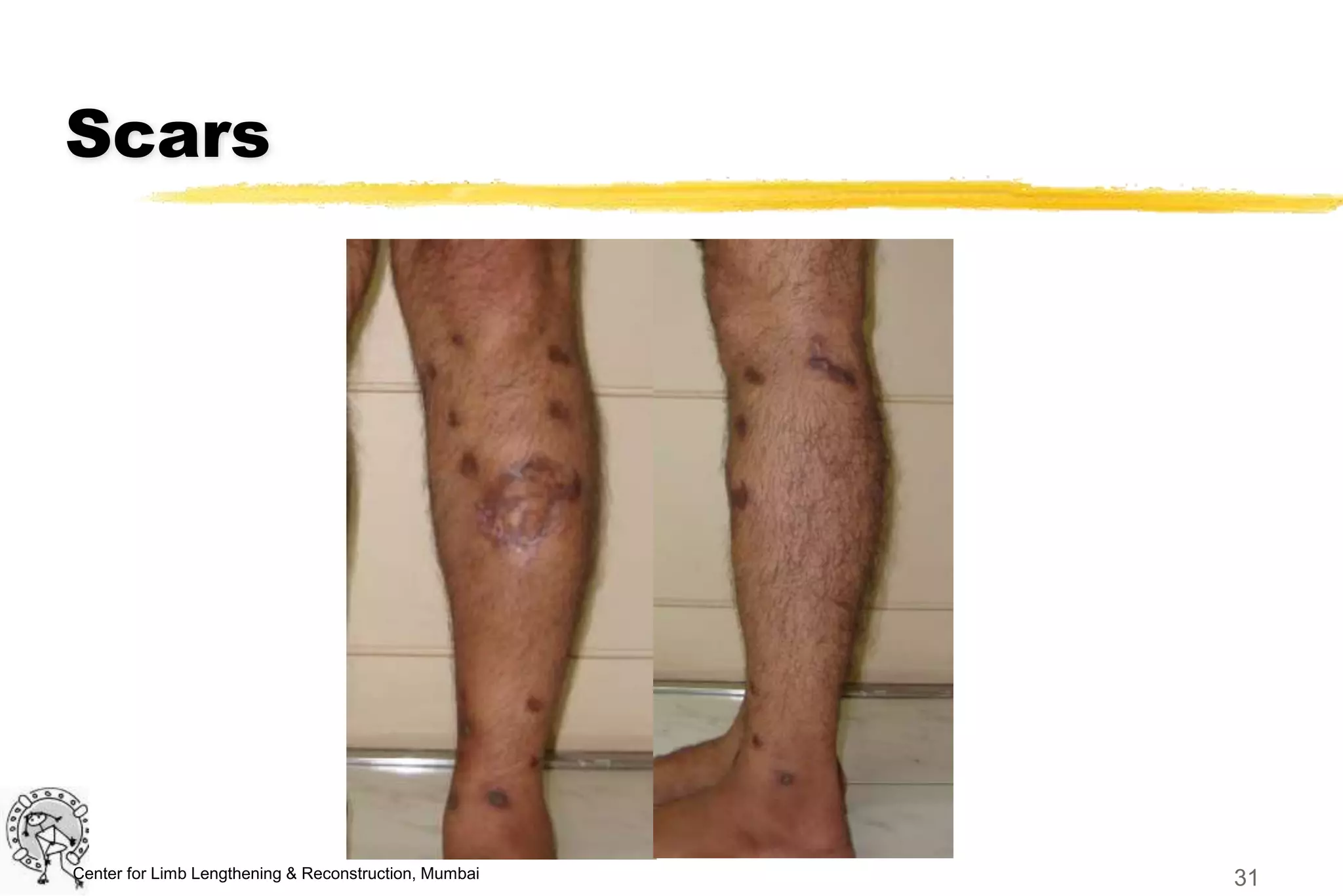 Use of Ilizarov fixator Hexapod apparatus for fracture prox tibia | PPTX