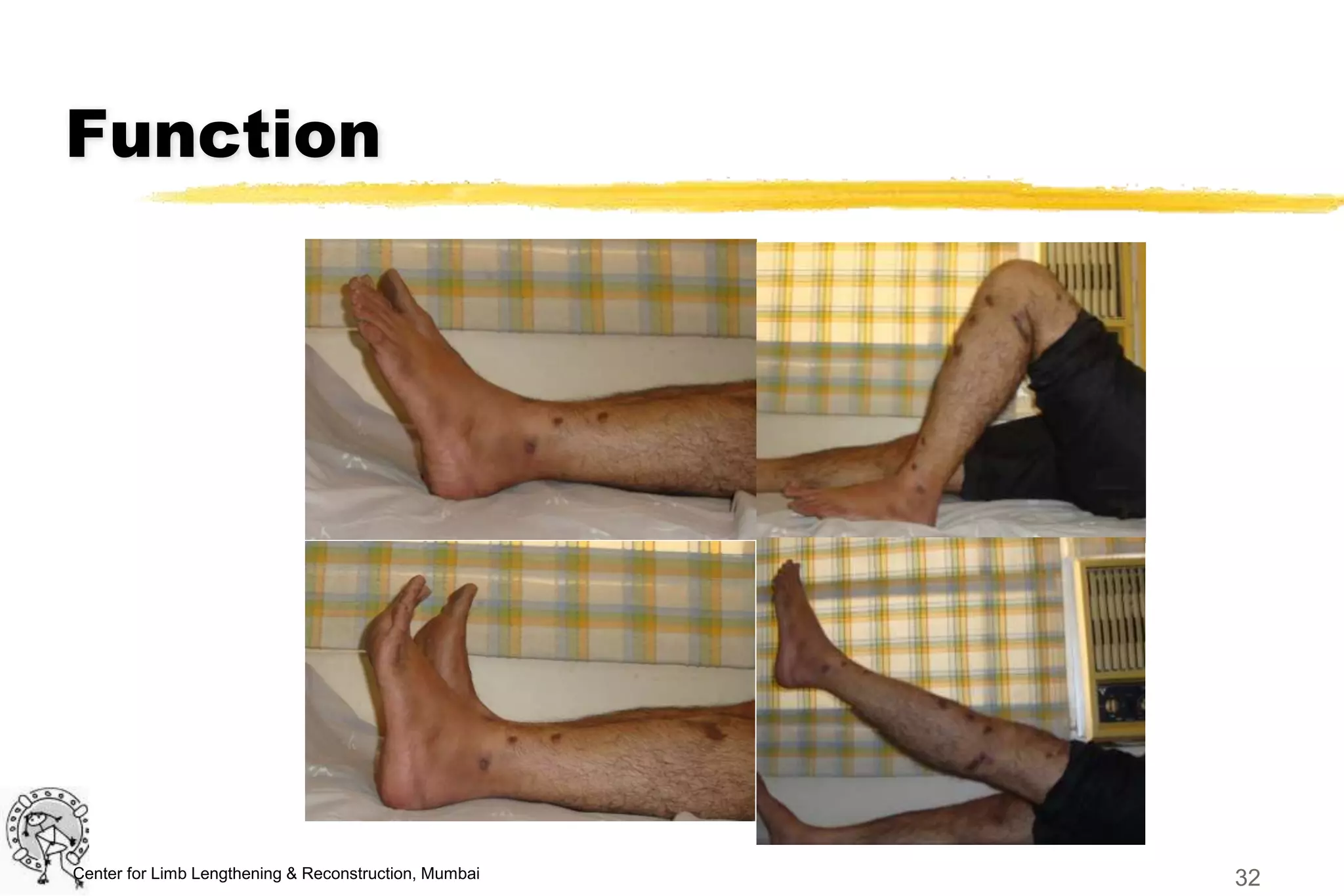 Use of Ilizarov fixator Hexapod apparatus for fracture prox tibia | PPTX