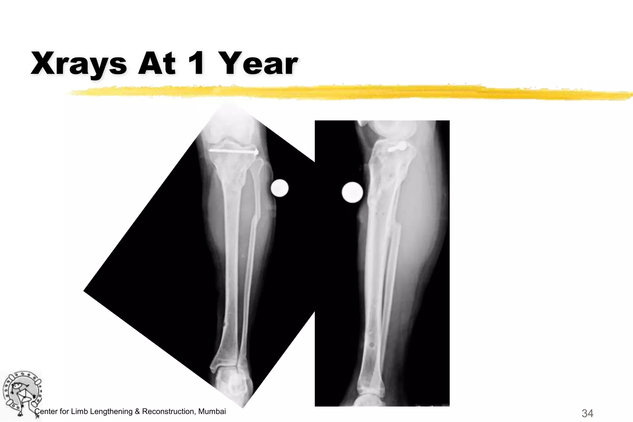 Use of Ilizarov fixator Hexapod apparatus for fracture prox tibia | PPTX
