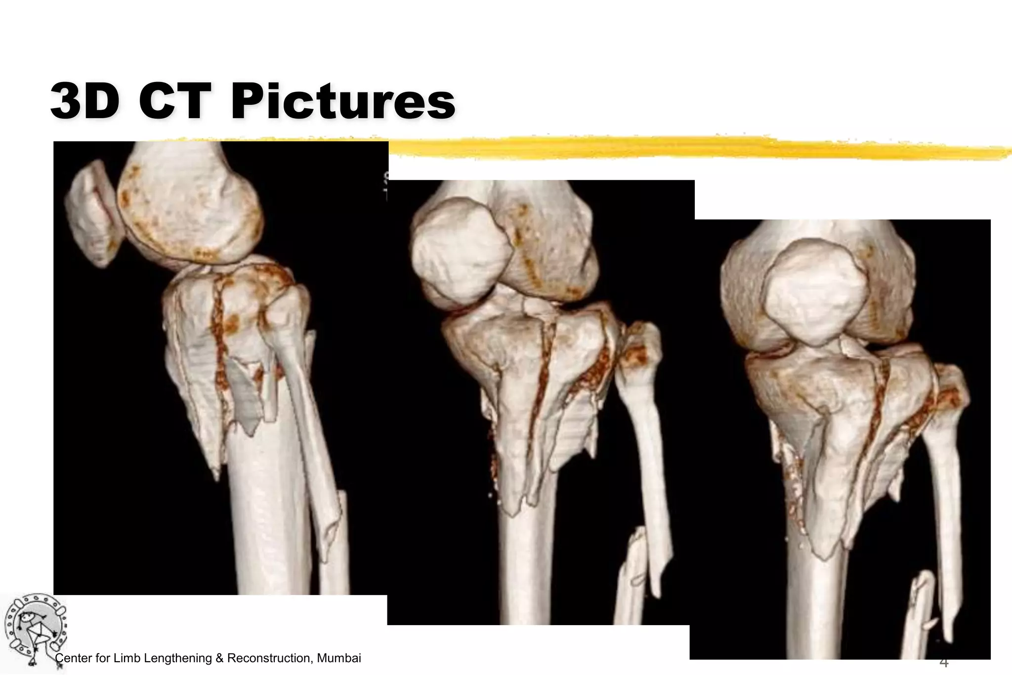 Use of Ilizarov fixator Hexapod apparatus for fracture prox tibia | PPTX