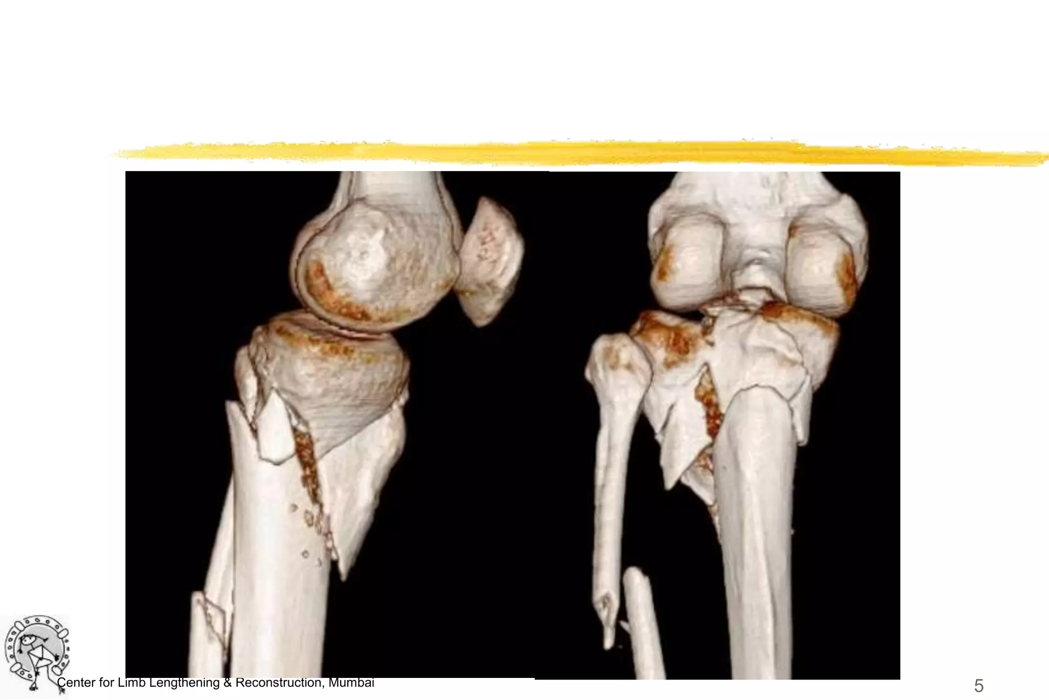 Use of Ilizarov fixator Hexapod apparatus for fracture prox tibia | PPTX