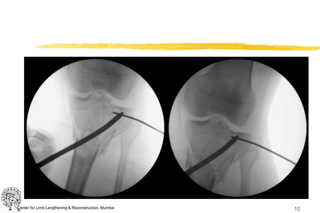Use of Ilizarov fixator Hexapod apparatus for fracture prox tibia | PPTX