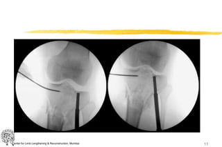 Use of Ilizarov fixator Hexapod apparatus for fracture prox tibia | PPTX
