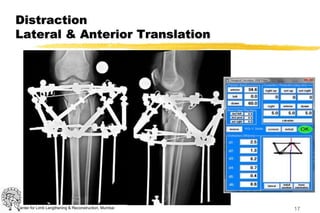 Use of Ilizarov fixator Hexapod apparatus for fracture prox tibia | PPTX