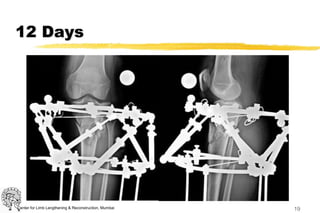 Use of Ilizarov fixator Hexapod apparatus for fracture prox tibia | PPTX