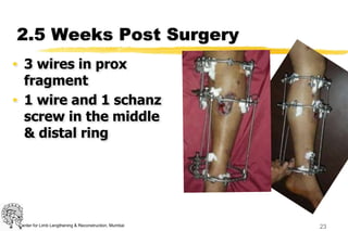 Use of Ilizarov fixator Hexapod apparatus for fracture prox tibia | PPTX