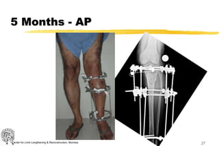 Use of Ilizarov fixator Hexapod apparatus for fracture prox tibia | PPTX