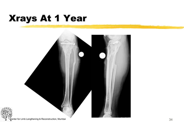 Use of Ilizarov fixator Hexapod apparatus for fracture prox tibia | PPTX