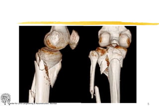 Use of Ilizarov fixator Hexapod apparatus for fracture prox tibia | PPTX