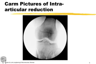 Use of Ilizarov fixator Hexapod apparatus for fracture prox tibia | PPTX