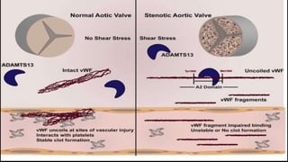 Heyde syndrome | PPTX