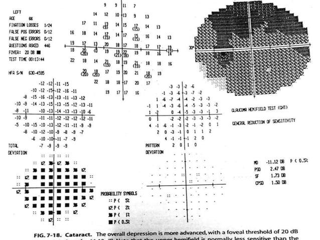 Hfa | PPTX | Eye and Vision Conditions | Diseases and Conditions