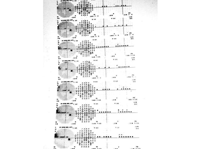 Hfa | PPTX | Eye and Vision Conditions | Diseases and Conditions