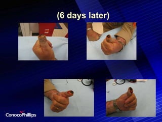 HF_Acid_Burn_Victim.ppt