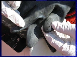 HF_Acid_Burn_Victim.ppt