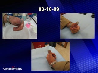 HF_Acid_Burn_Victim.ppt